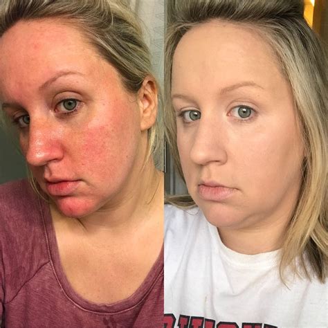 Reddit User Shows Before And After Photos Using It Cosmeticss Bye Bye