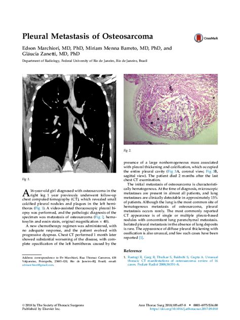 Pdf Pleural Metastasis Of Osteosarcoma
