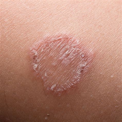 How Do I Know If I Have Ringworm Ringworm Fungal Infection Skin