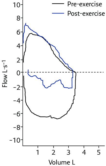 Spirometry Before And After Exercise In The Girl Described In Case 1 Download Scientific