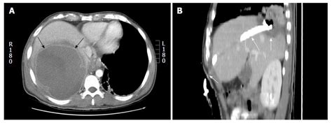 Imaging Guided Percutaneous Interventions In Hepatic Dome Lesions Tips