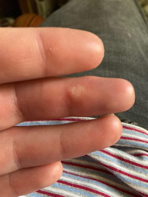 Ulcer Update A Few Months Later Rscleroderma