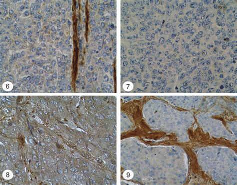 Adrenal Cancer Immunostained With At2 Antibody Negative Staining Of