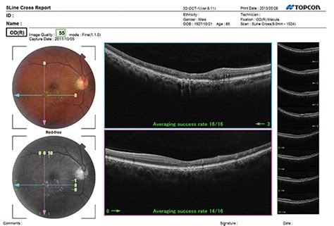 Topcon 3d Oct 1 Maestro Optik Medikal