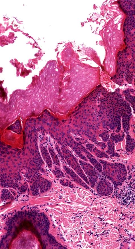 Pathology Of Dilated Pore Of Winer Histology Slides Pathology Skin