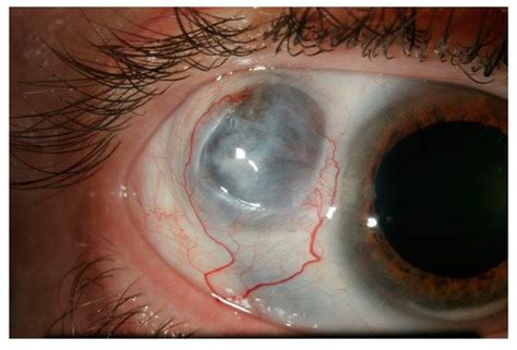 Necrotizing Scleritis