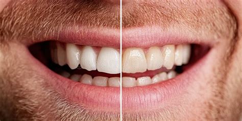 Male Smiling With Bright White Teeth After Professional Whitening