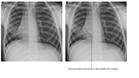 Chest Xray Interpretation In Icu Deranged Physiology