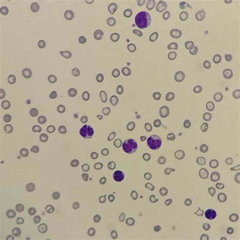 Cleaved Lymphocytes Identification And Differentiation