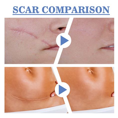 Silicone Scar Patch Leading Cosmetics Manufacturer In Guangzhou