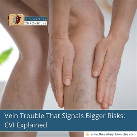 Chronic Venous Insufficiency Cvi Everything You Need To Know