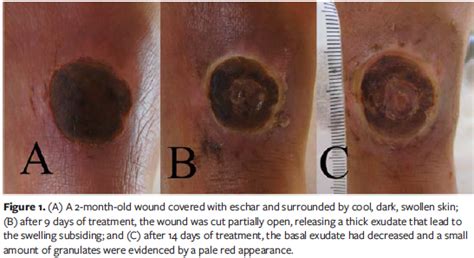Lower Limb Nonhealing Ulcers Associated With Chronic Diabetes A Case