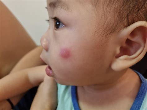 What Is This Flea Bite Rbabies