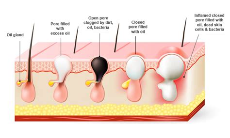 Hormonal Acne Jawline