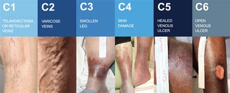 Chronic Venous Statis Are You At Risk For Venous Stasis Dermatitis