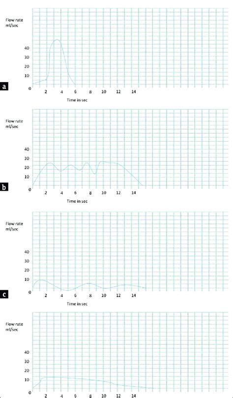 Graphic Representation Of Various Uroflow Patterns A Superflow Download Scientific Diagram Graphic Representation Of Various Uroflow Patterns A Superflow Download Scientific Diagram