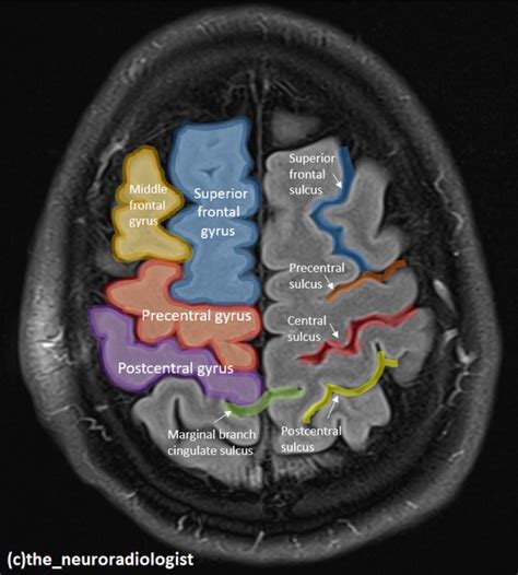 Superior Frontal Gyrus Mri