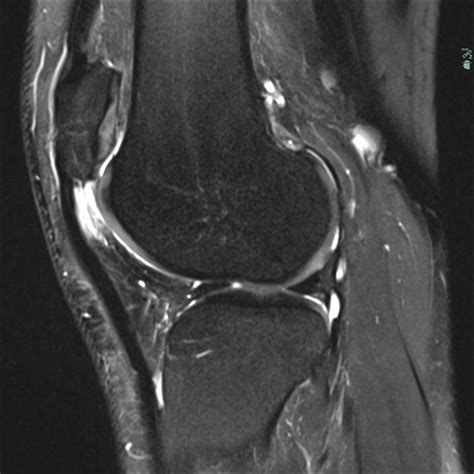 For Højt Siddende Knæskal Patella Alta