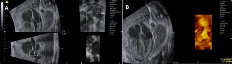 a image including the three orthogonal planes of the fetal heart