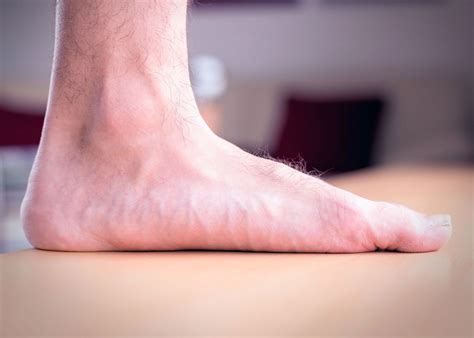 What Is Pes Planus Caused By Algeos