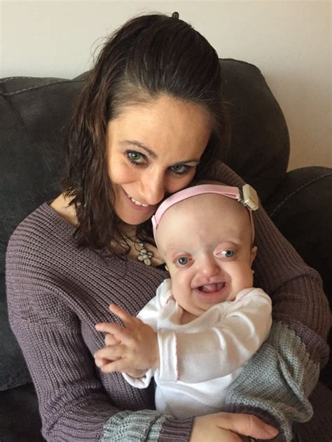 Girl Born With Severely Deformed Head Smiles Despite Strangers
