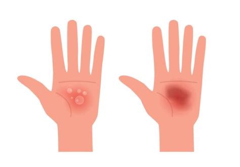 7 Symbolic Meanings Of Dreaming About Blisters Dream Psychological