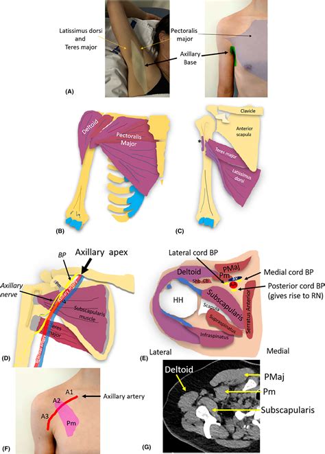 Sonographic Localisation Of Lymph Nodes Suspicious Of Metastatic Breast Cancer To Surgical