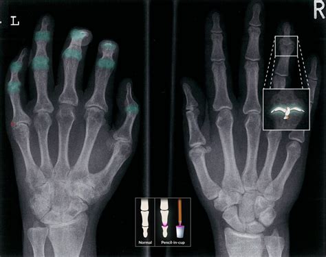 Pencil In Cup Deformity Psoriatic Arthritis
