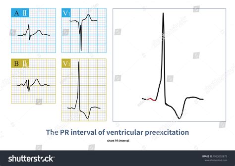 Individuals Atrioventricular Accessory Pathway Partial Ventricular