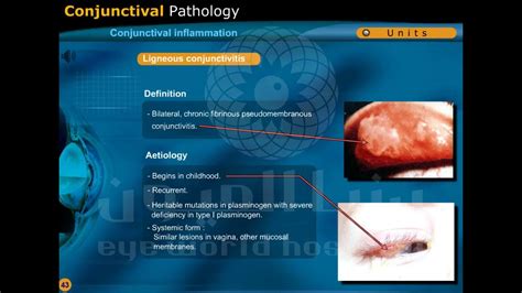 Conjunctival Inflammation Youtube