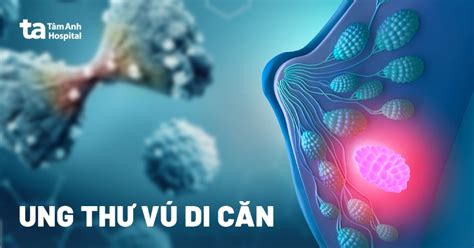 Ung Thư Vú Di Căn Mbc Triệu Chứng Và 4 Vị Trí Di Căn Phổ Biến