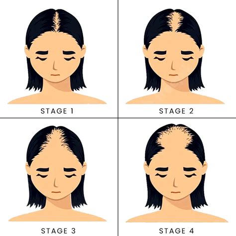 Hair Loss In Females Hfhg Bangladesh Causes And Treatment Options