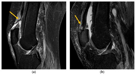 Quadriceps Tendon Calcification