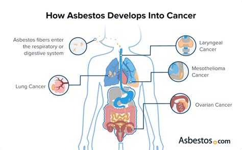 Lung Cancer Asbestosis
