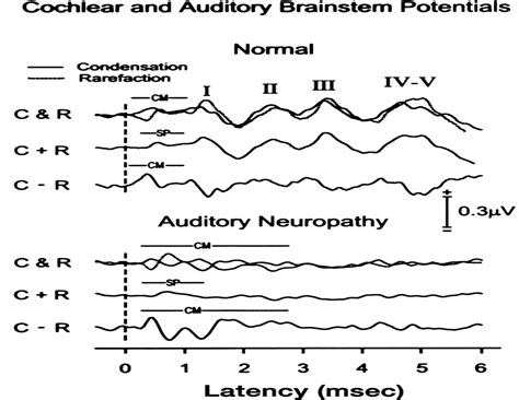 Cochlear Receptor Microphonic And Summating Potentials Oto Ear