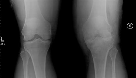 Pigmented Villonodular Synovitis Md Searchlight