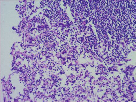 Hande Staining Of The Biopsy Samples Exhibited Tumor Cells With Atypia