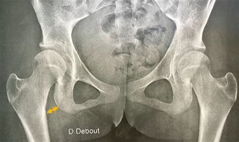 Hip Preservation Patient Stratification A Bad Candidate For
