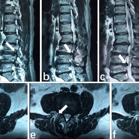Cpr Mri Grading Schematic A Shows Grade 0 No Nerve Root Compression