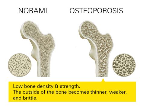 Brittle Bone Disease Vs Osteoporosis At Dorothy Bufkin Blog