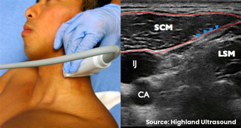 Superficial Cervical Plexus Nerve Block