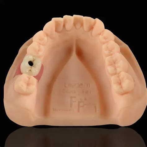 What Is A Chrome Cobalt Denture Golden Smile Dental Lab