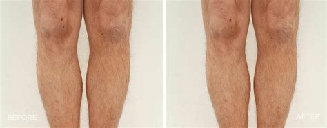 Super Inductive System Muscle Atrophy Isomatic Integrative Health