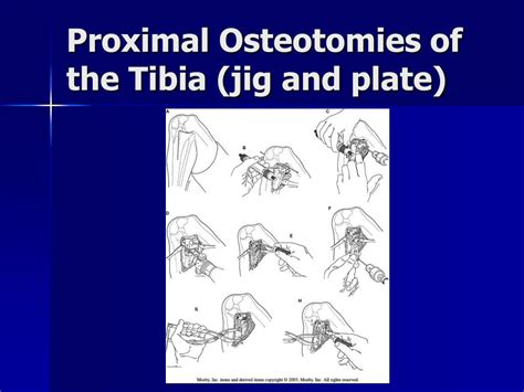 Ppt Osteotomies About The Knee Powerpoint Presentation Free Download