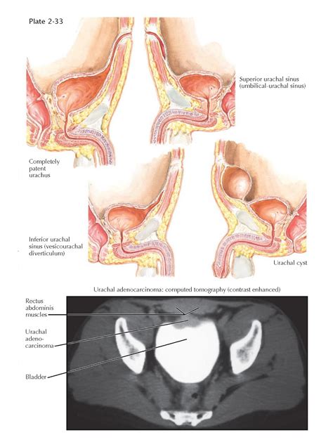 Anomalies Of The Urachus Pediagenosis