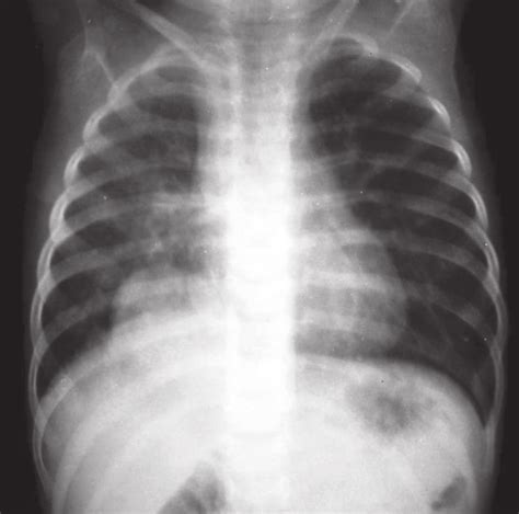 Radiograph Of Chest Showing Herniation Of The Liver In Right Hemithorax