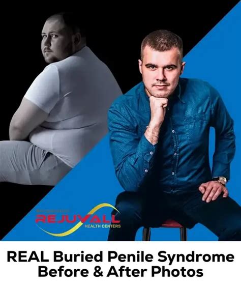 Guide To Turtling Syndrome