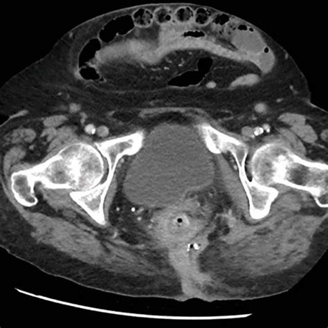 Image Showing A Buttock Abscess Download Scientific Diagram