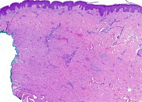 Dermatofibrosarcoma Pathology Outlines Pathology Outlines Fibrous