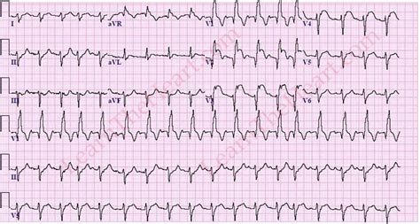 Anterior St Elevation Myocardial Infarction Mi With Rbbb Ecg 1
